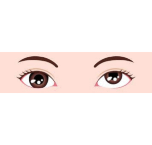 Squint Eye Exercises | Vision Therapy for Squint Eye Correction